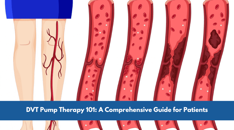 Deep Vein Thrombosis Pump Therapy 101: A Comprehensive Guide for Patients